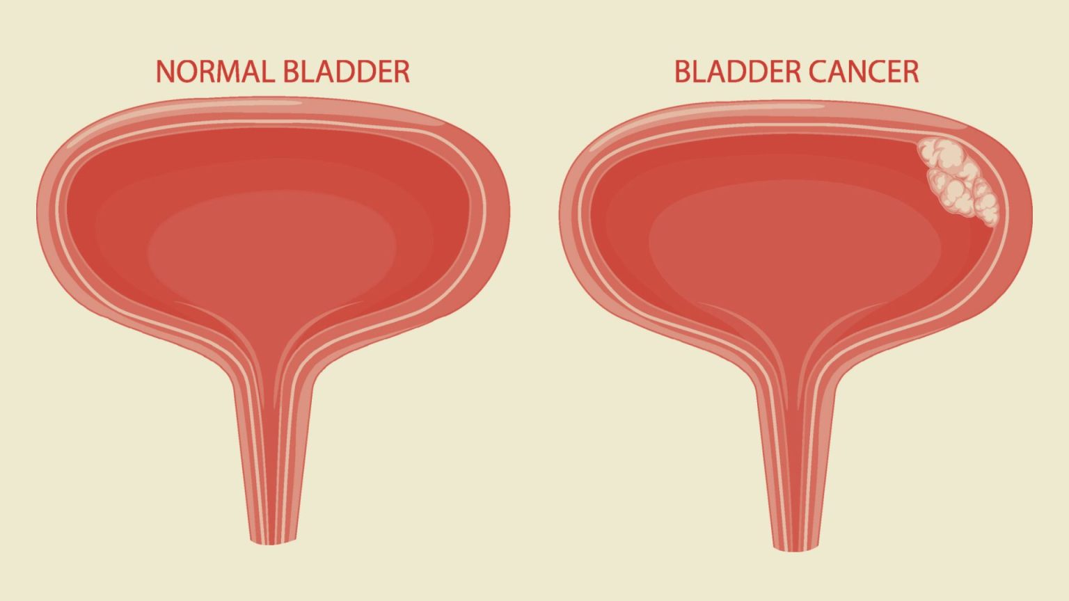 Bladder Cancer - Urologist.my