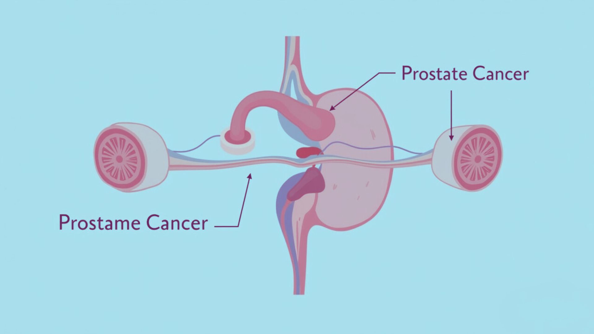 Prostate Cancer - Urology Specialist Clinic in Kuala Lumpur Malaysia